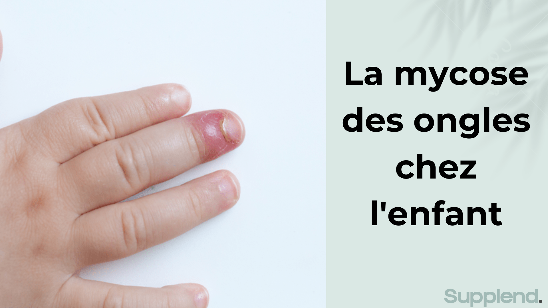 La Mycose des Ongles Chez l’Enfant : Symptômes & Traitements